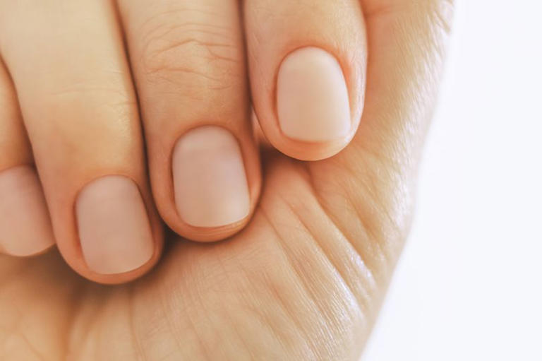 Fingernail warning signs that could mean high cholesterol