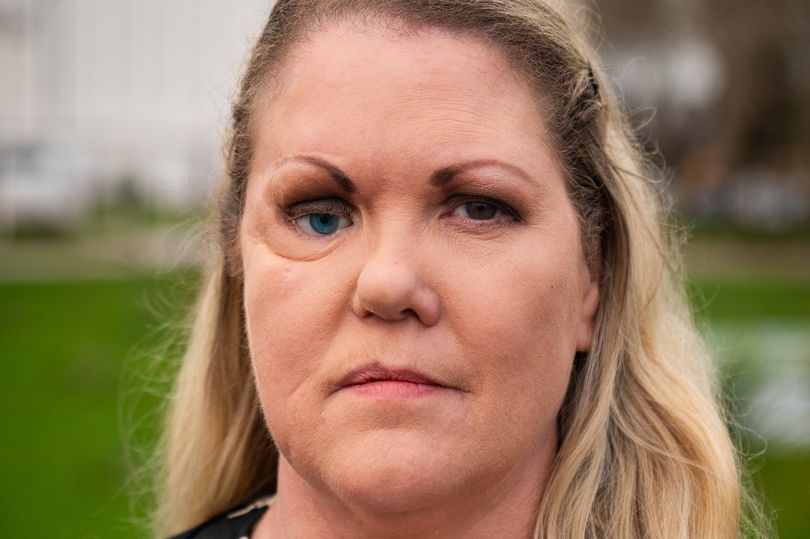 Woman's facial reconstruction turns to horror as infection 'eats' her ...