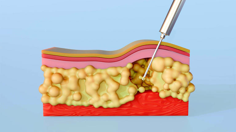 Advertisements promising a 'dream body' with minimal risk get little ...