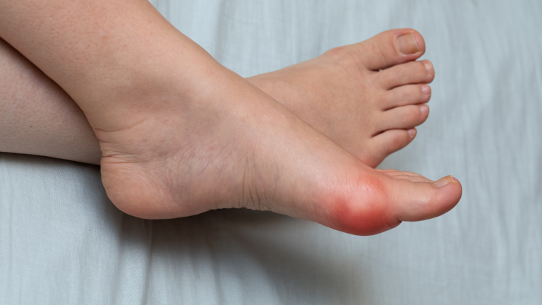 Why cold-triggered swelling and redness hit fingers and toes the most ...