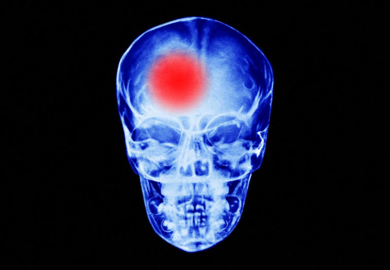 The eight warning signs of a stroke – and what to do
