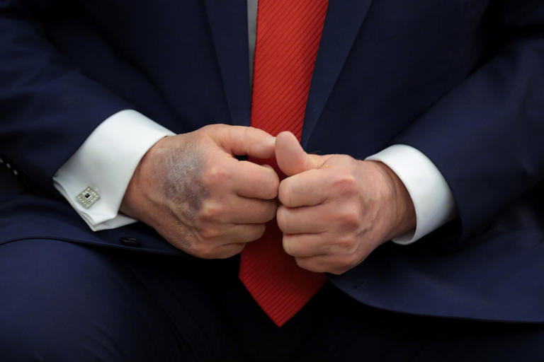 The White House needs a new line on the bruises on Trump’s hands