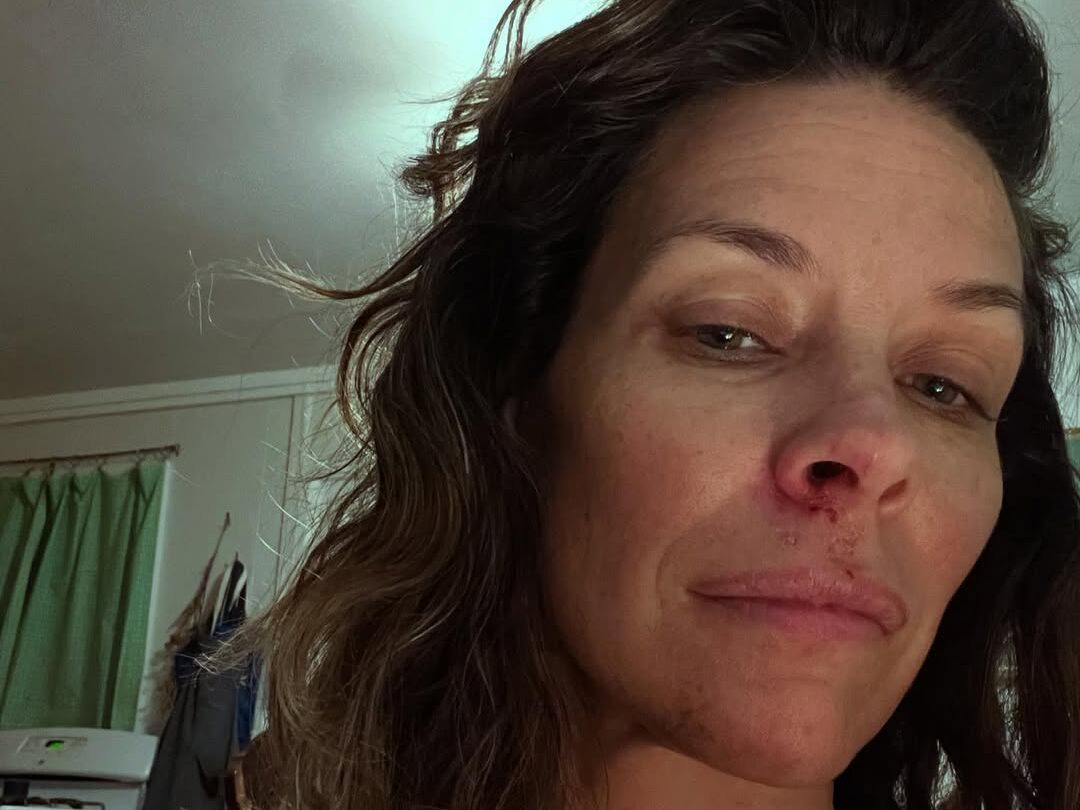 Evangeline Lilly, rivelazione shock dopo l’incidente: "Danni al cervello"
