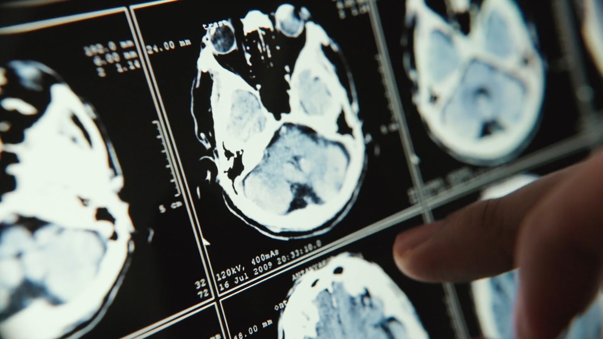 $32K Alzheimer drugs offer modest brain benefits