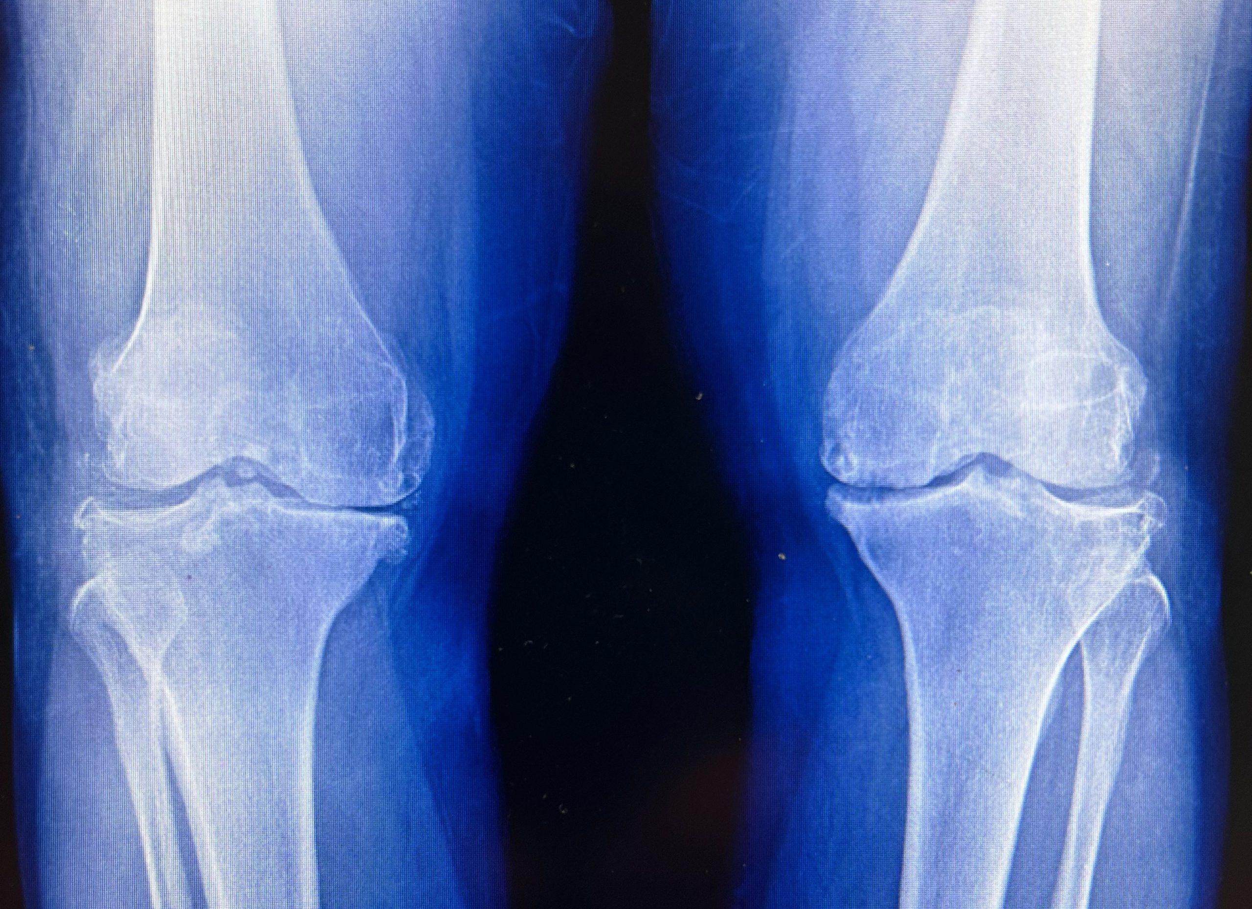 Stanford scientists revolutionize arthritis treatment with knee ...