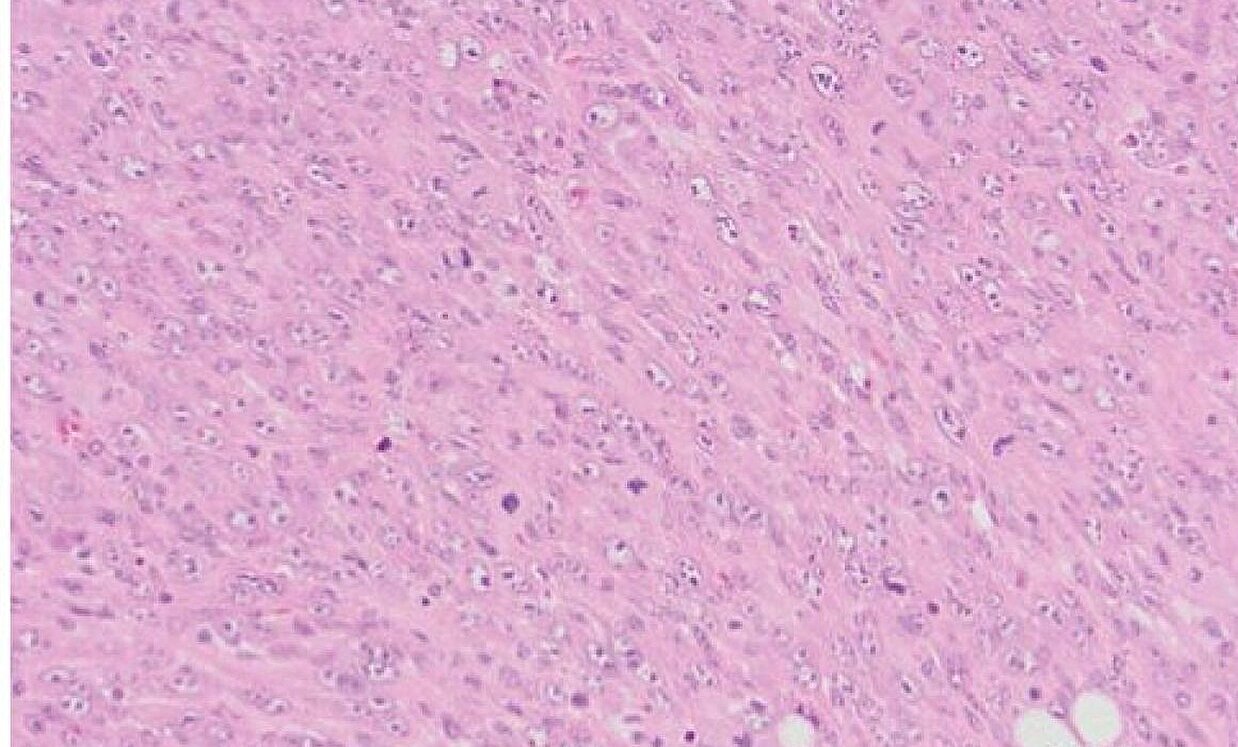 Lifting cancer's invisibility cloak: Dying tumor cells alert the immune ...