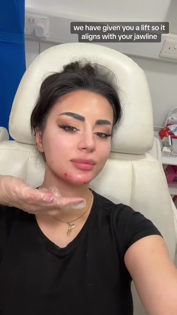 Trying fat dissolving and Arabian facelift at Amara Clinic