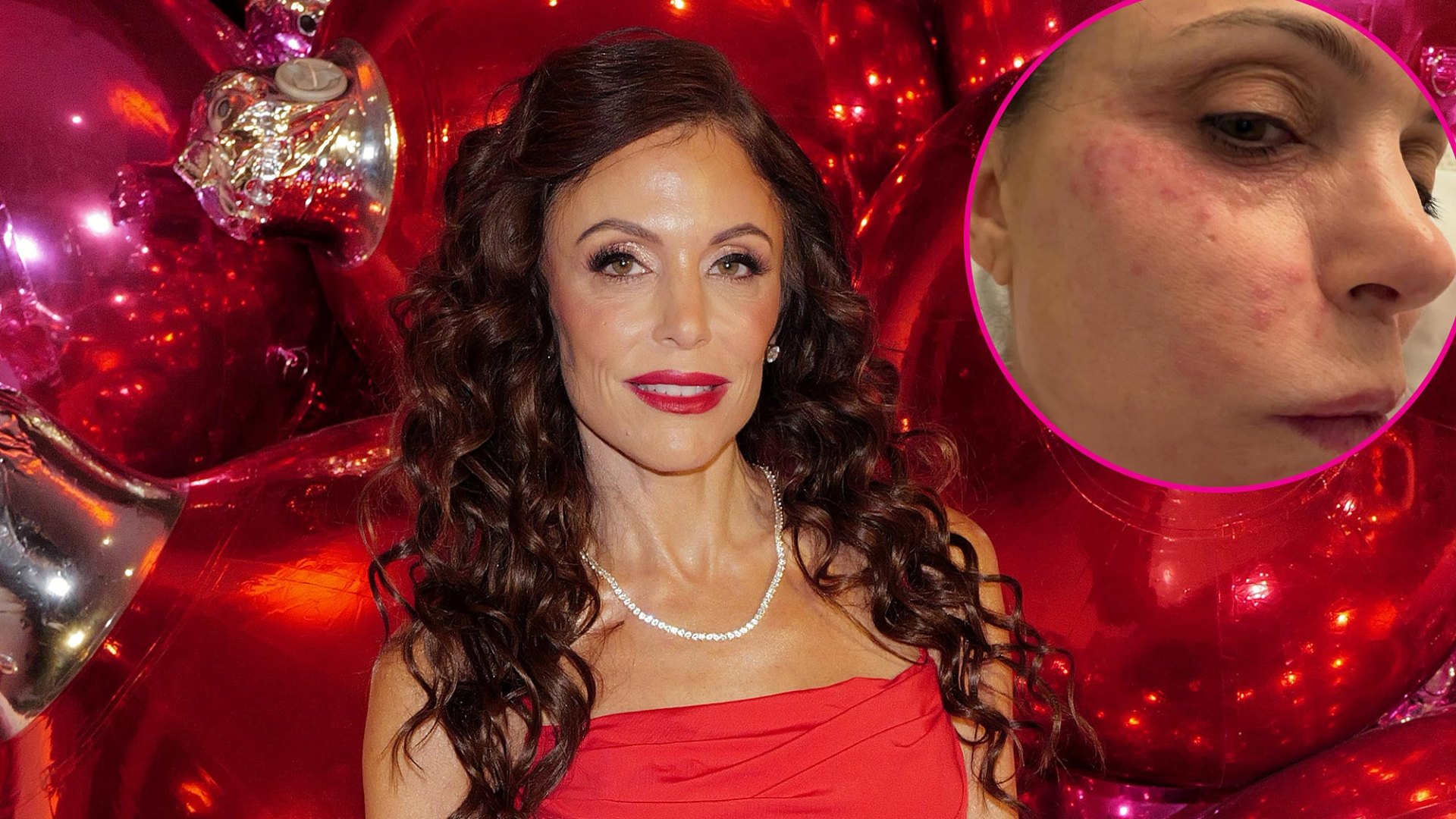 Bethenny Frankel shows face rash from bacterial infection on St. Bart's ...