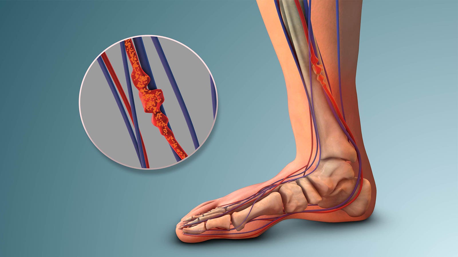 DVT assessment strategy safely expands rule-out