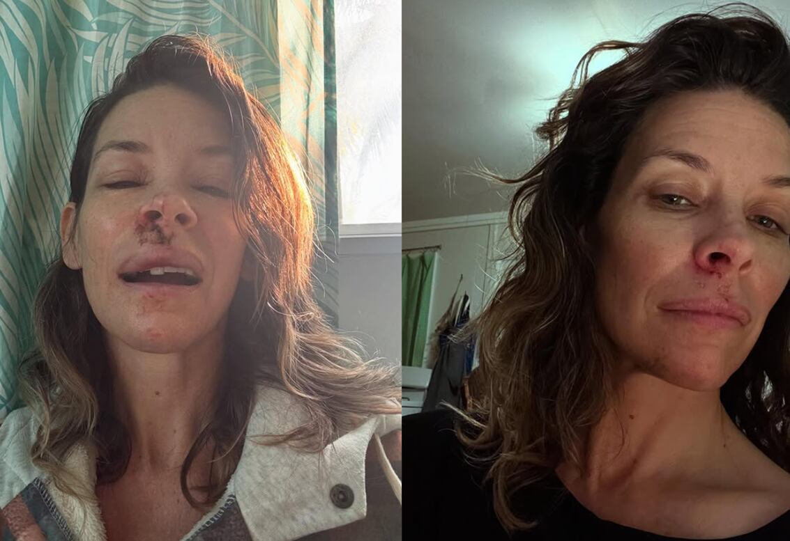 Evangeline Lilly reveals brain injury, treatment