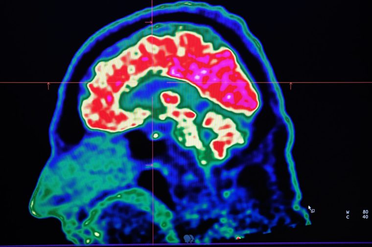 The eight warning signs of a stroke – and what to do