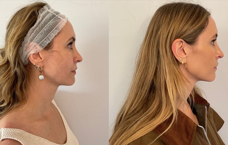 7 best skin-tightening treatments for a youthful glow, from injectables ...