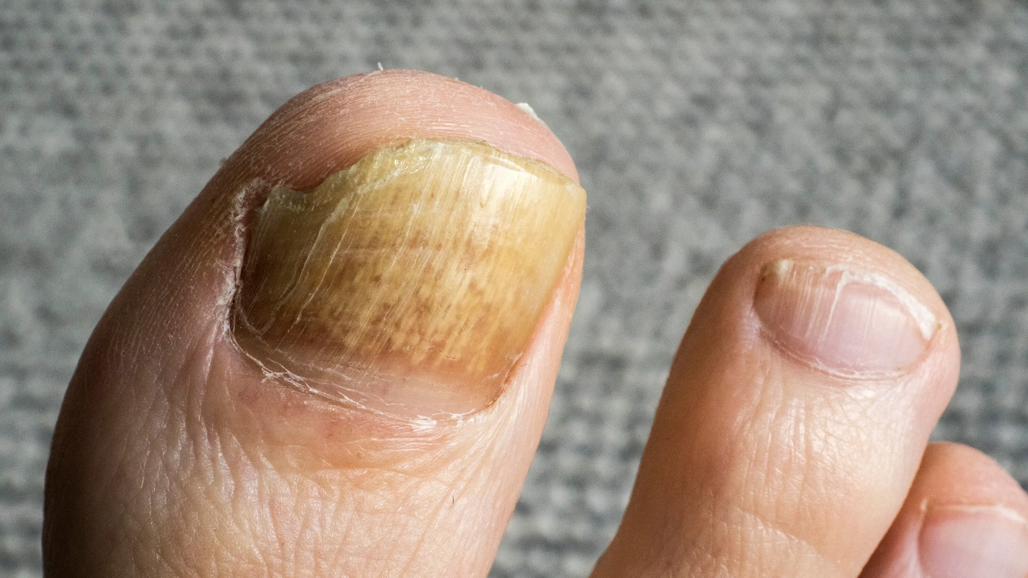 Mange børn lever med svampeinfektion uden at vide det: 'Det er ...