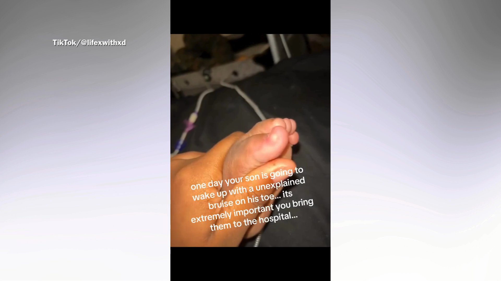 Mom notices unexplained bruise on son’s toe—then comes shocking diagnosis
