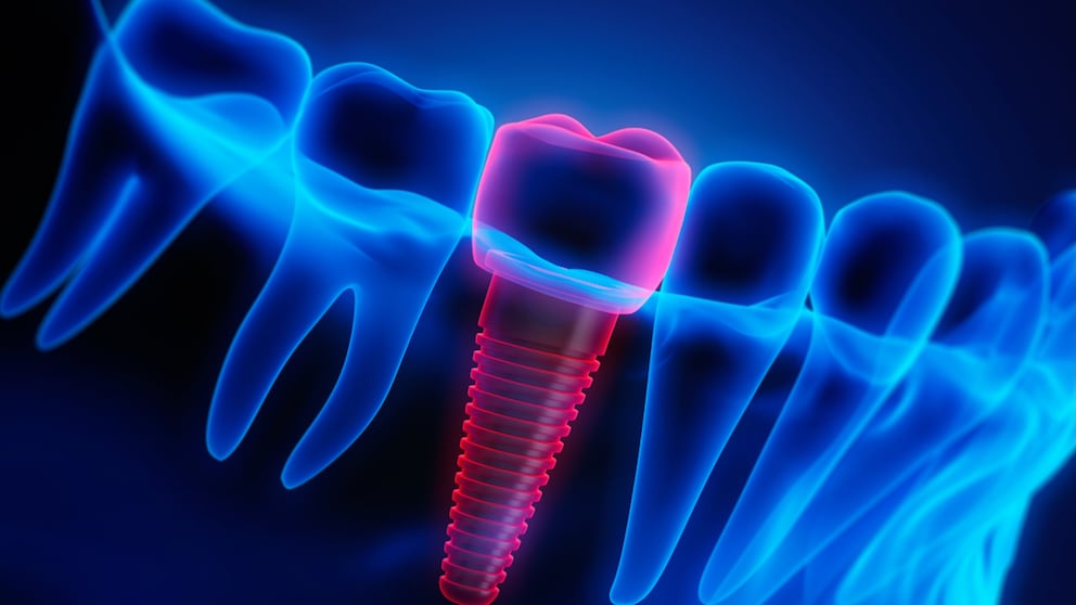 Dr. Martin Jaroch: "Excessive use of dental implants is not the right ...