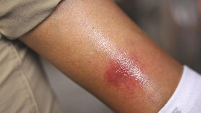 10 signs of an infected bug bite—plus treatment options