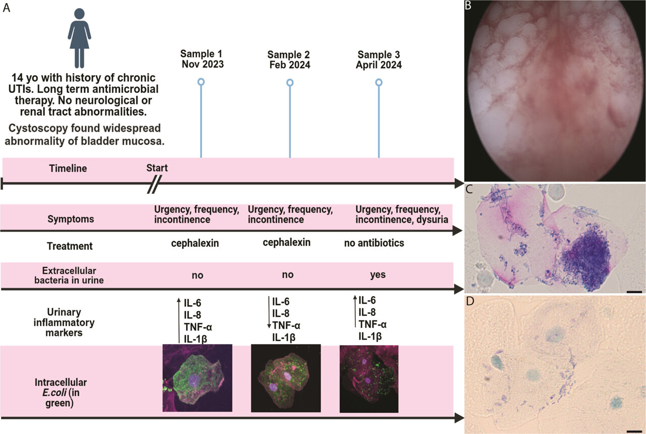 New database to target chronic UTIs—a long-overlooked condition that ...