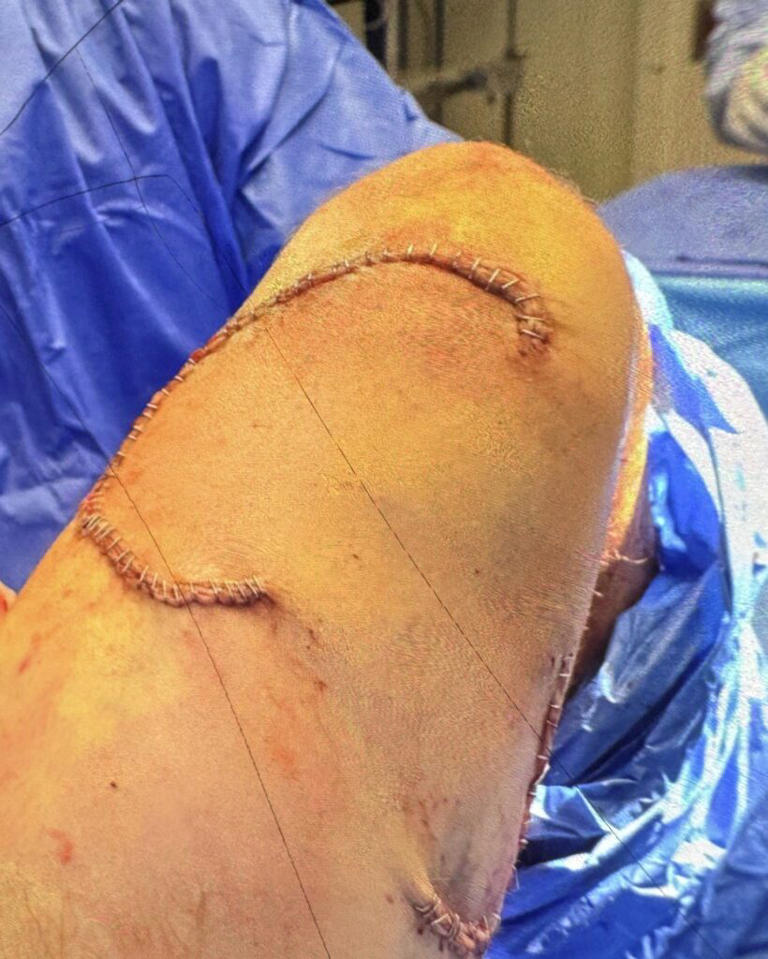 Spearfisherman survived shark attack by making tourniquet from shredded ...