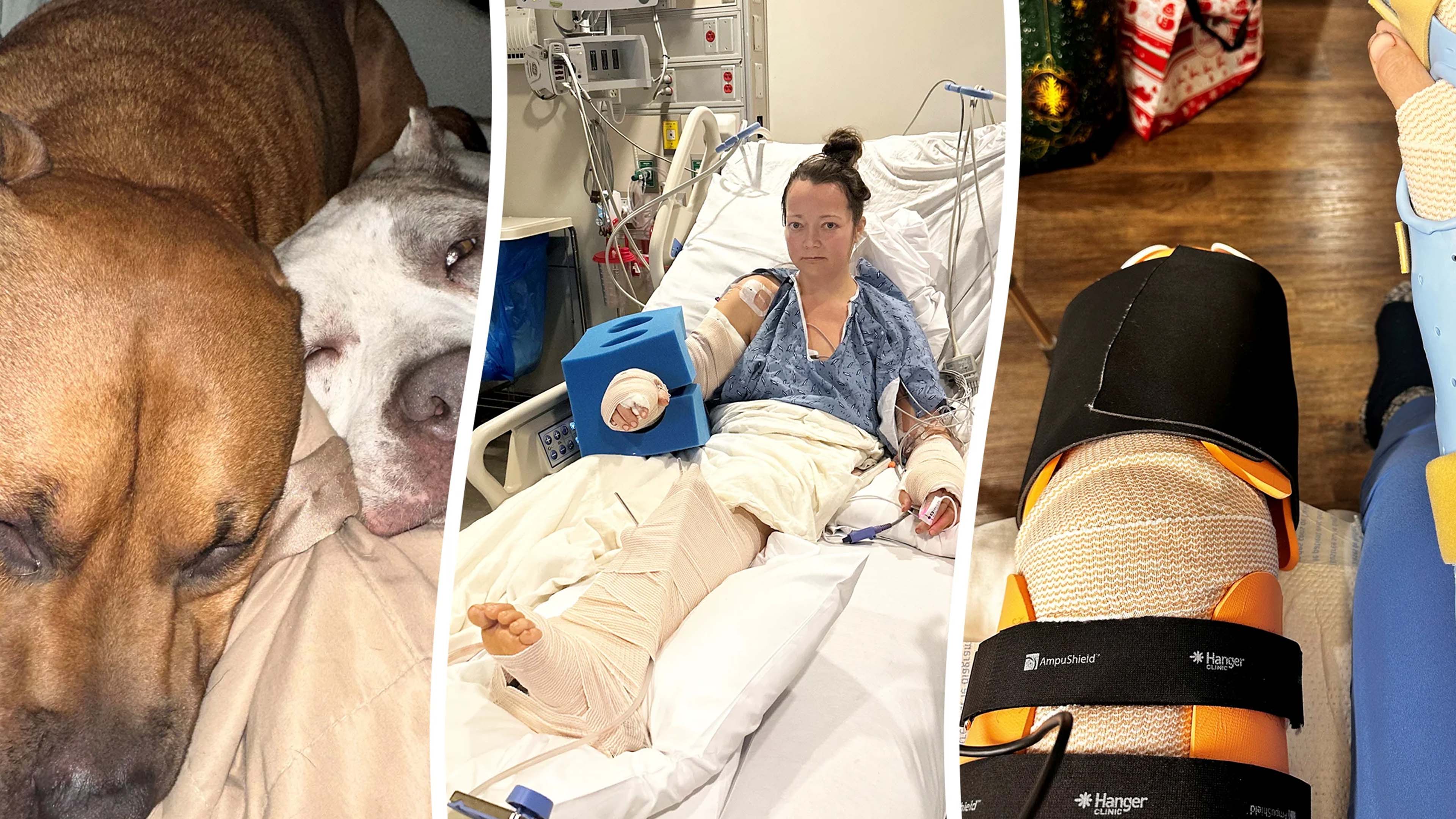 Mum has leg amputated after her own dog leaves it hanging by a thread