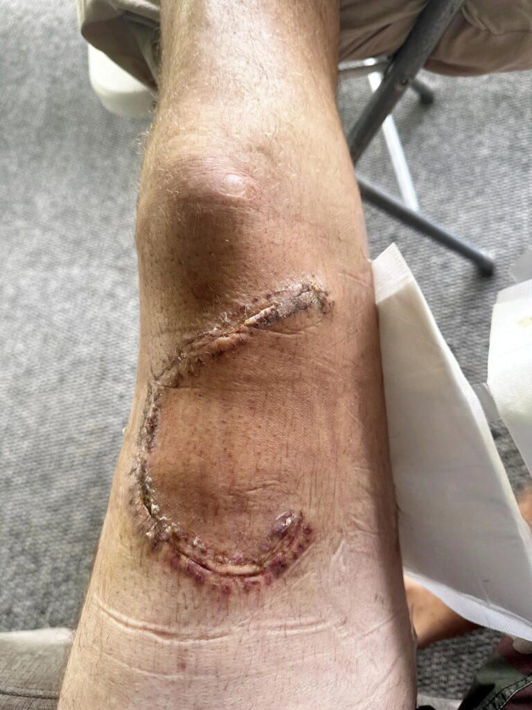 Spearfisherman survived shark attack by making tourniquet from shredded ...