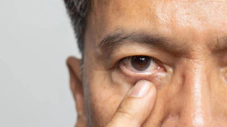 Glaucoma explained: Why doctors call it the silent thief of sight