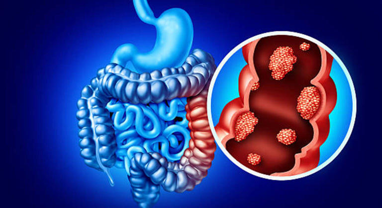 Exelixis falls as final analysis of zanzalintinib Phase 3 data disappoints