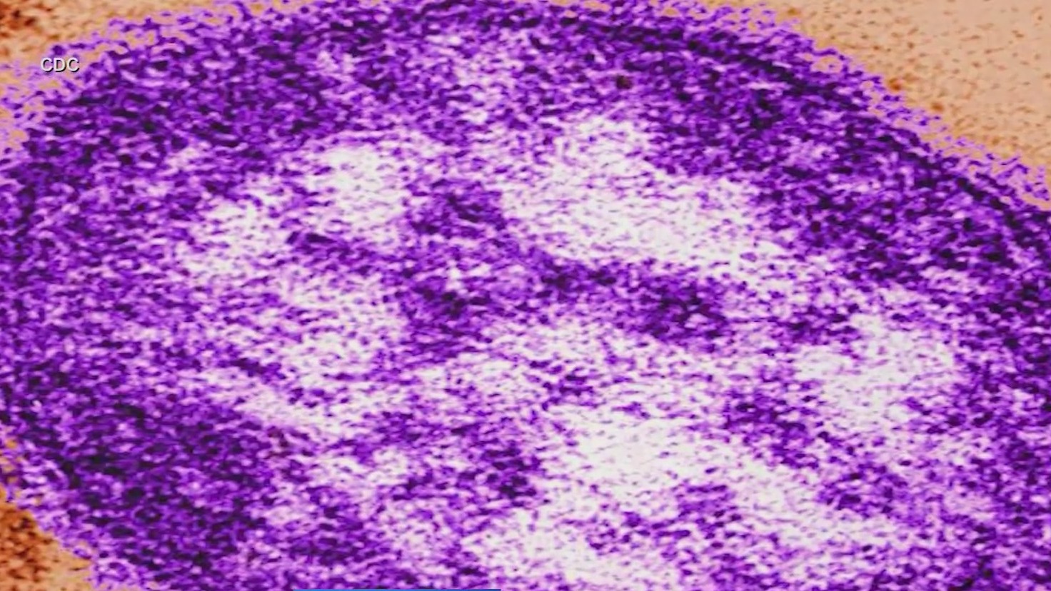 CDC: Measles cases surge past 2,100, threatening US elimination status