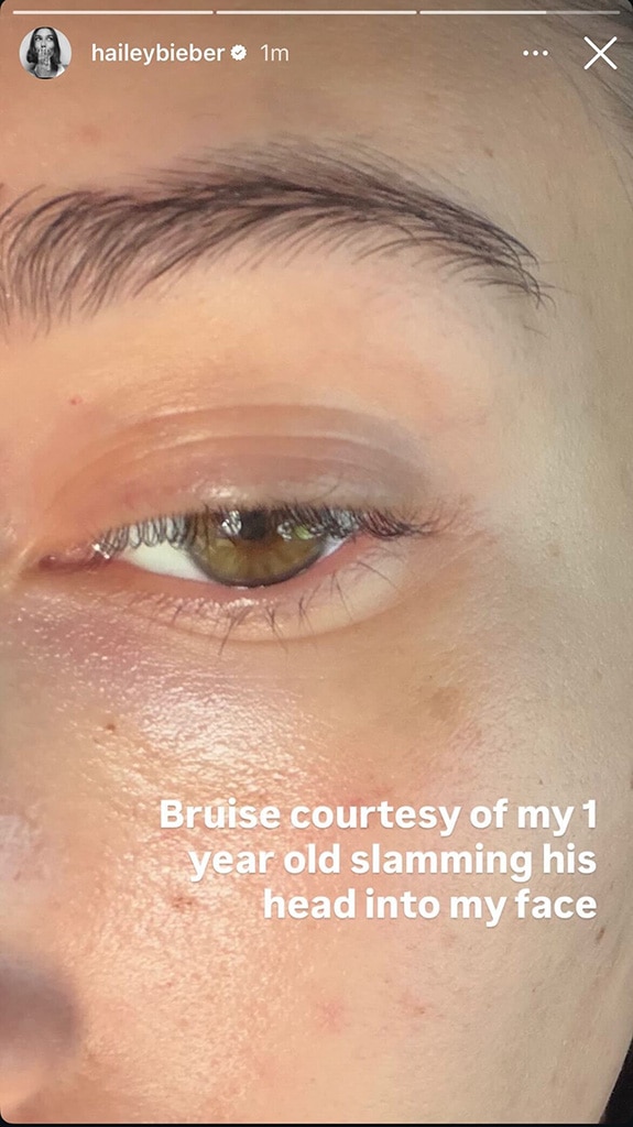 Hailey Bieber reveals bruised eye from baby Jack