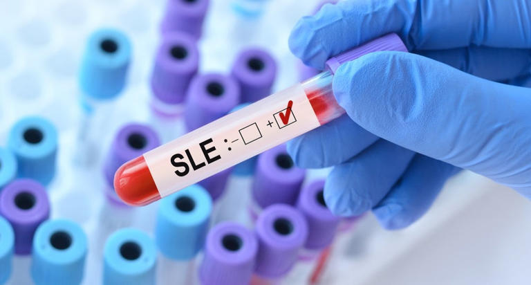 J&J’s Imaavy posts win in Phase II SLE trial