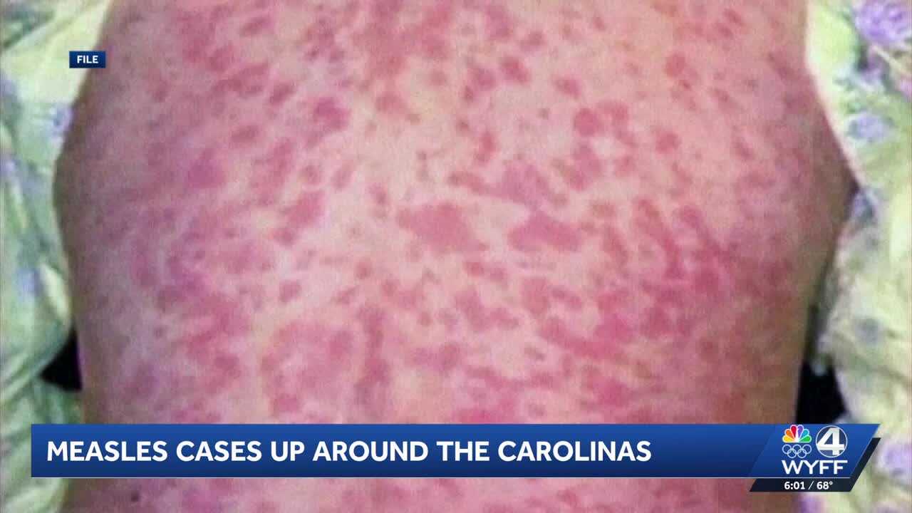 Measles outbreak in the Upstate leads to increased vaccinations