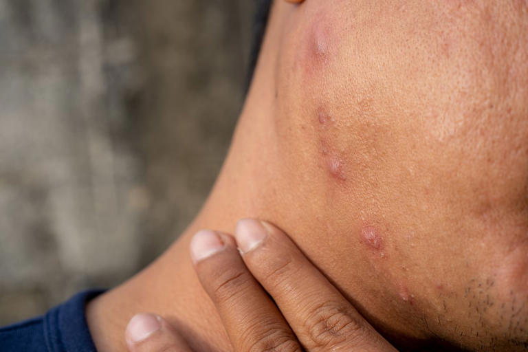 What causes neck acne—and how can you get rid of it?