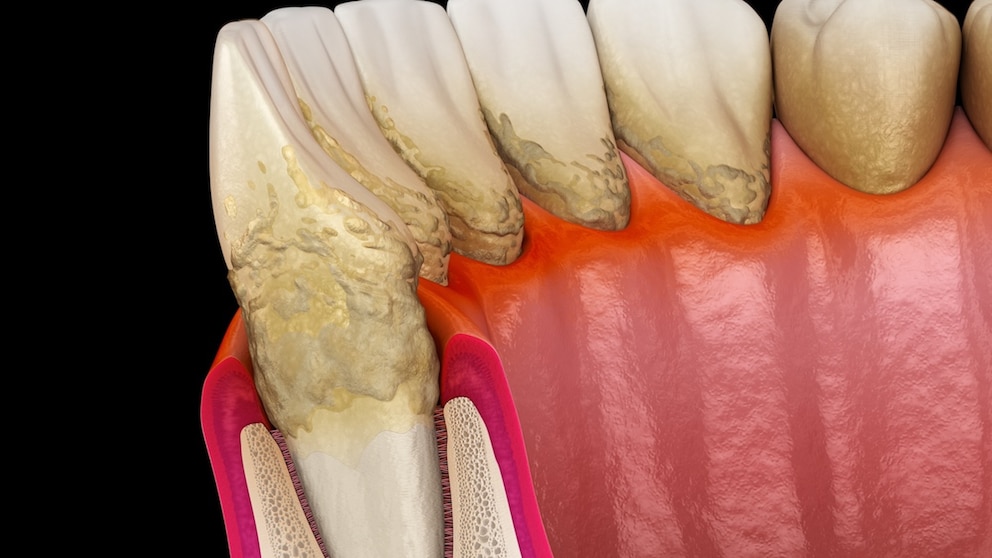 New substance appears to protect against periodontitis