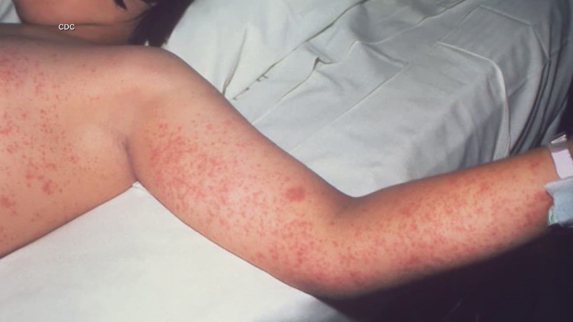 Measles rates hit another high as vaccination rates lag