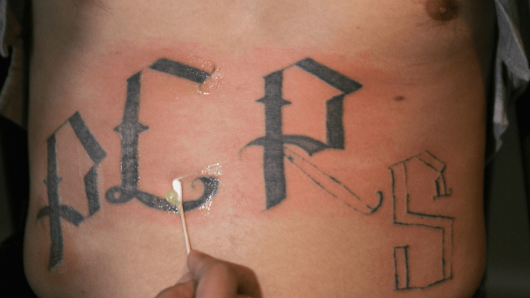 How a gang tattoo removal program is helping people start fresh