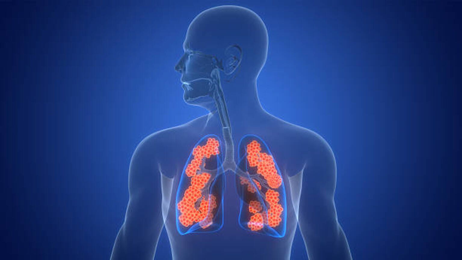 Krystal Biotech rises on new phase 1 data for cystic fibrosis asset