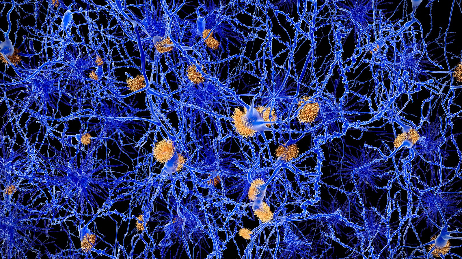 Alzheimer's risk may be driven by a single gene