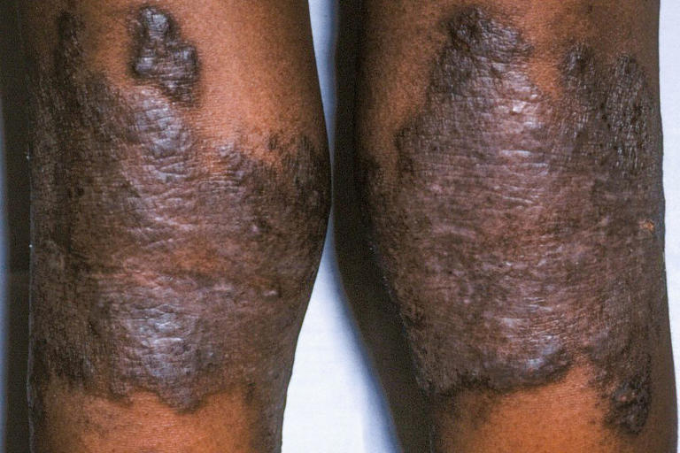 Eczema on dark skin: Common triggers, symptoms, and treatment