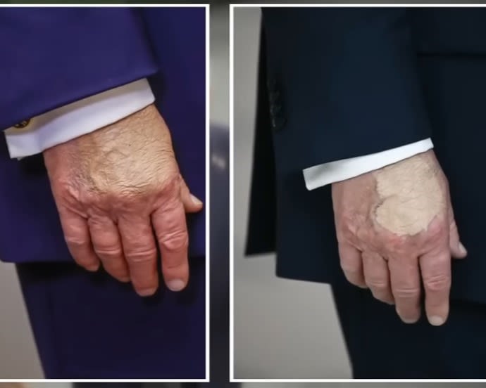 President Donald Trump applies makeup to conceal bruise as health ...