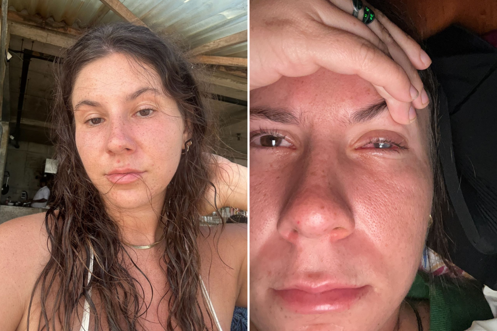 Woman, 21, wears contact lenses, ends up blind due to rare parasite on eye