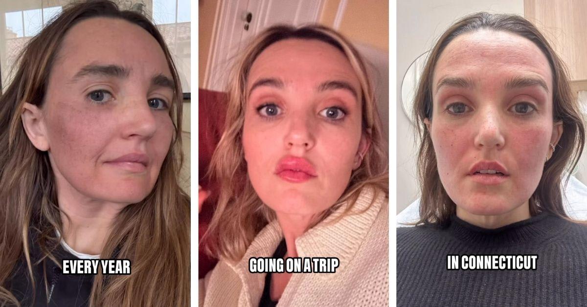 Chloe Fineman's 'Botched' med spa saga: Shocking before and after photos