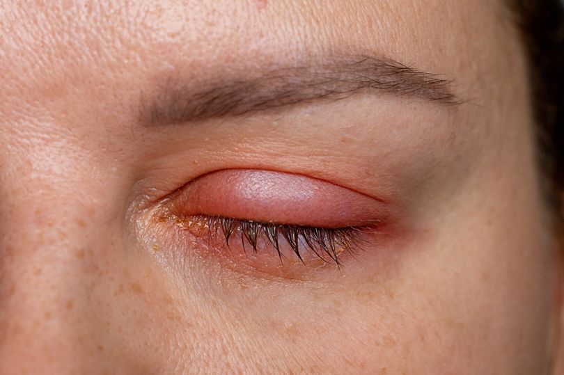 People with common health conditions could be more at risk of stye