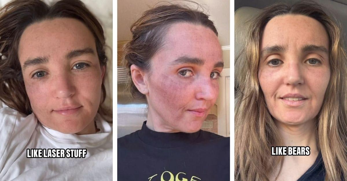 Chloe Fineman's 'Botched' med spa saga: Shocking before and after photos