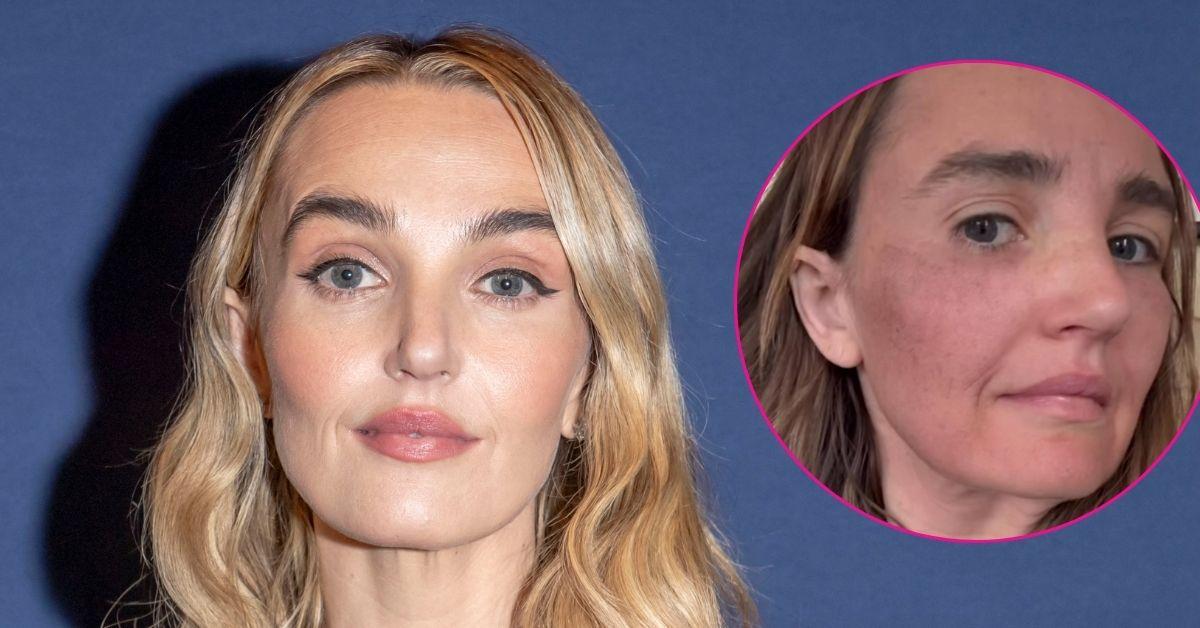 Chloe Fineman S Botched Med Spa Saga Shocking Before And After Photos