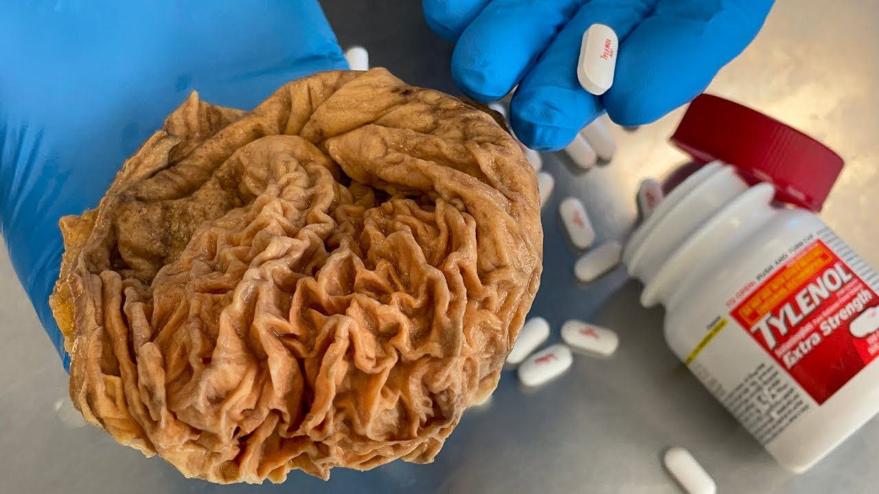 The Tylenol mistake: Are you taking too much?