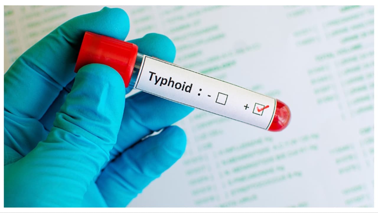 Typhoid: 7 early symptoms that signal a serious infection