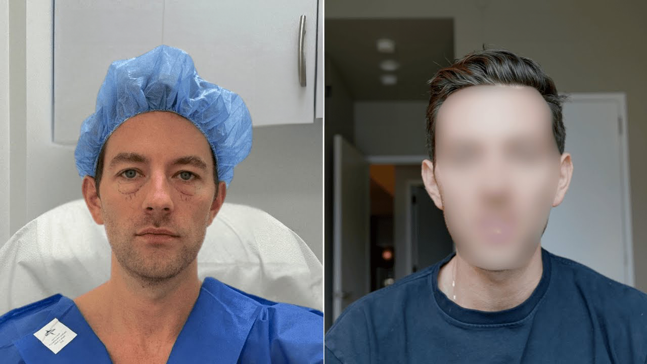 Eye bag removal surgery: What to know