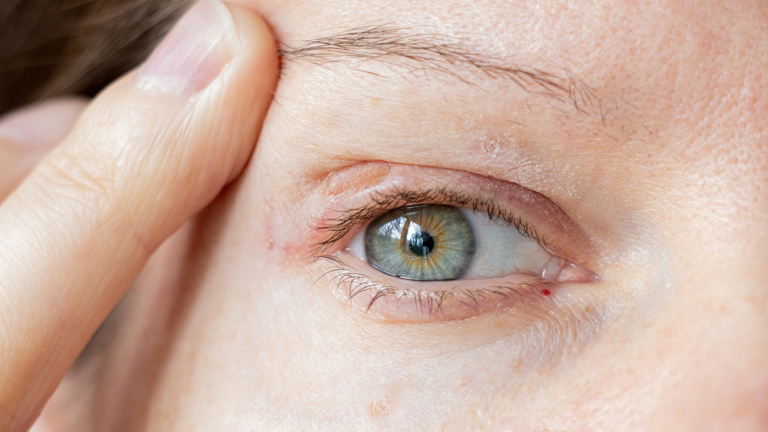 What is Marcus Gunn syndrome, in which the eyelid moves with the jaw ...