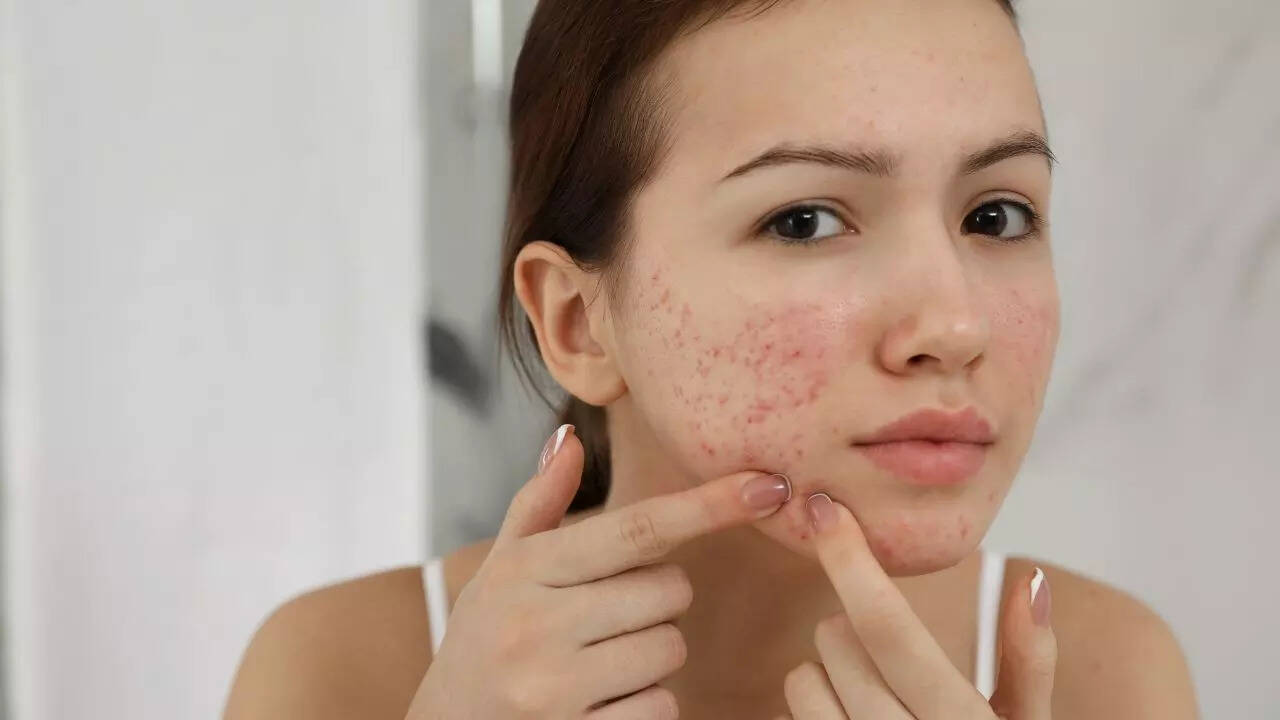 13 things that secretly trigger acne at home and cause breakouts ...