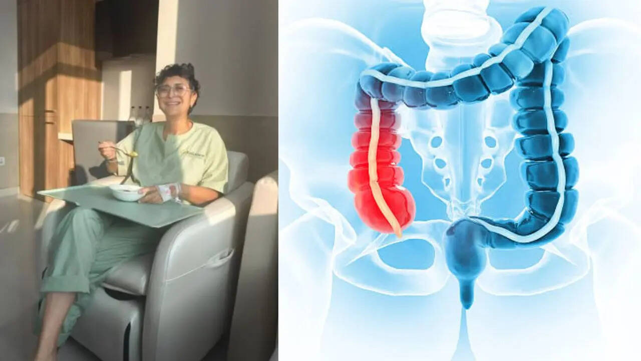 Kiran Rao undergoes appendix surgery: What is appendicitis, symptoms to ...