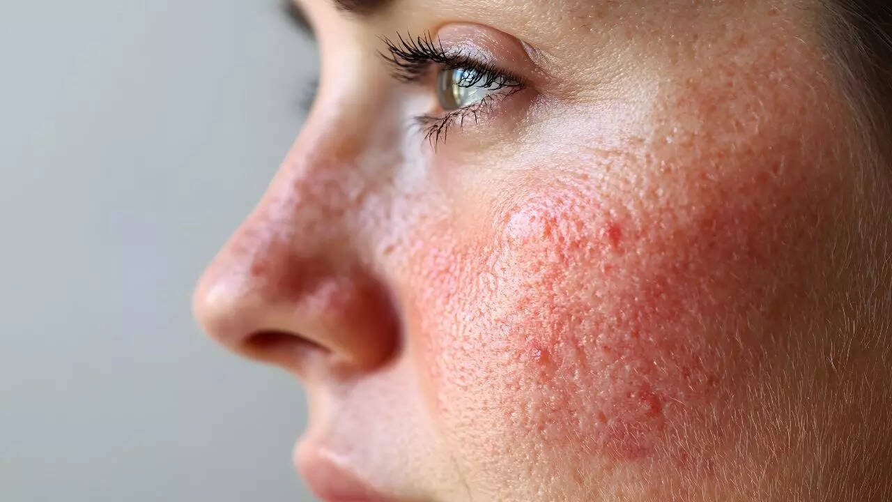 13 things that secretly trigger acne at home and cause breakouts ...
